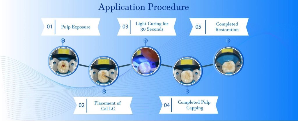 Prevest DenPro Cal LC | Buy Genuine | Buy Direct