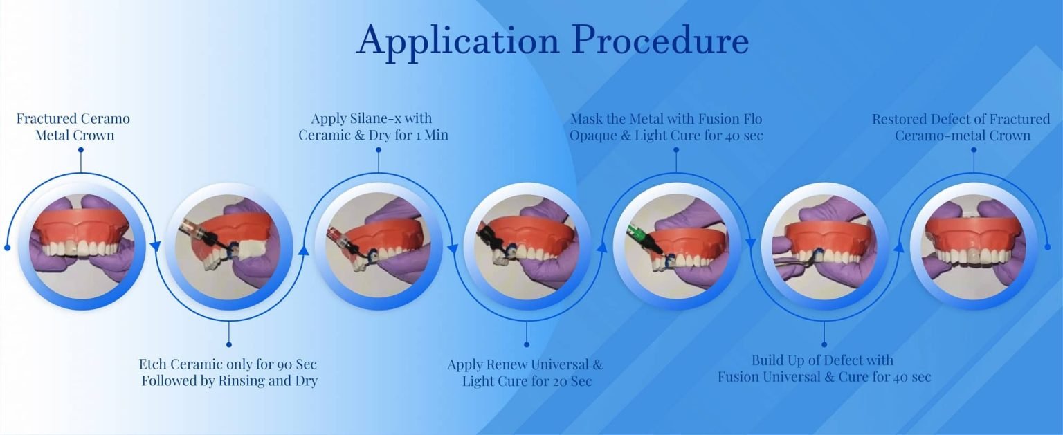 Prevest DenPro ACE Repair Kit | Buy Genuine | Buy Direct